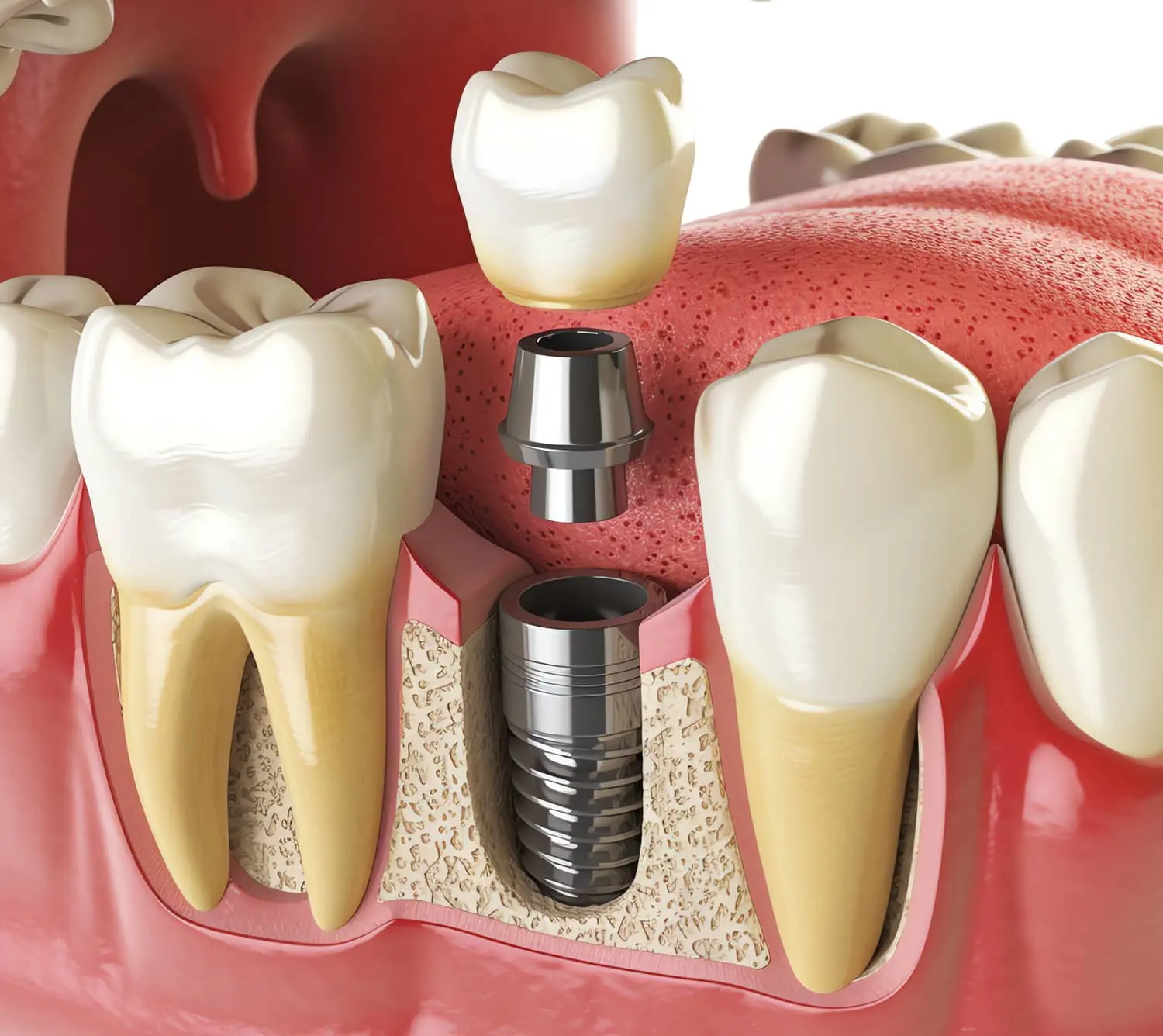 Kan eldre / seniorer få tannimplantat? - OralCare tannklinikk ...