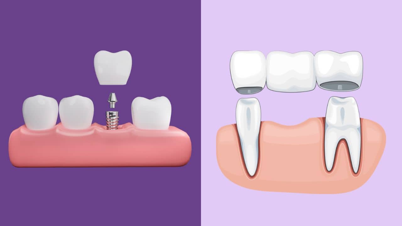 Fordeler og ulemper: Tannbro vs. implantat - OralCare tannklinikk ...