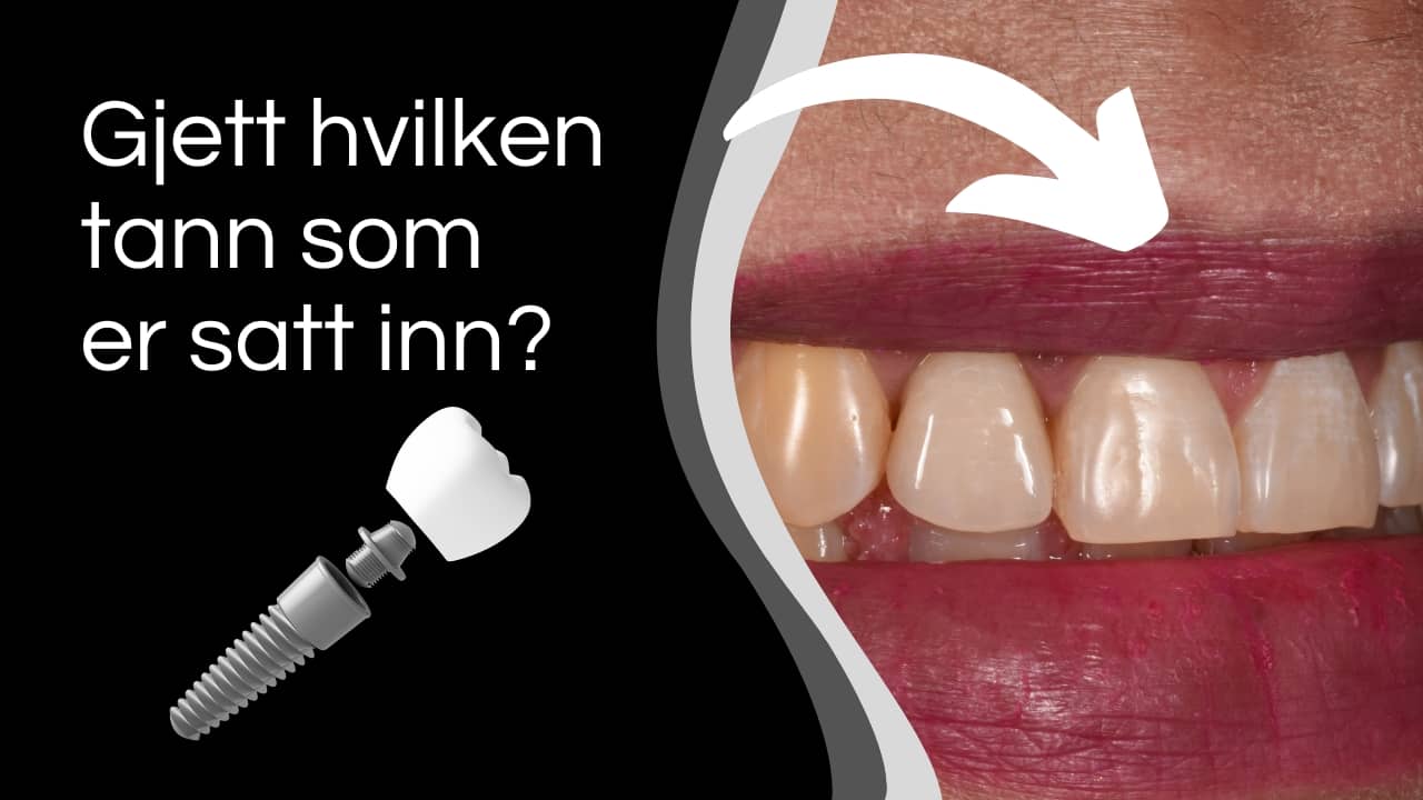 Fra knekt til perfekt: Kan du se hvilken tann som er krone her ...